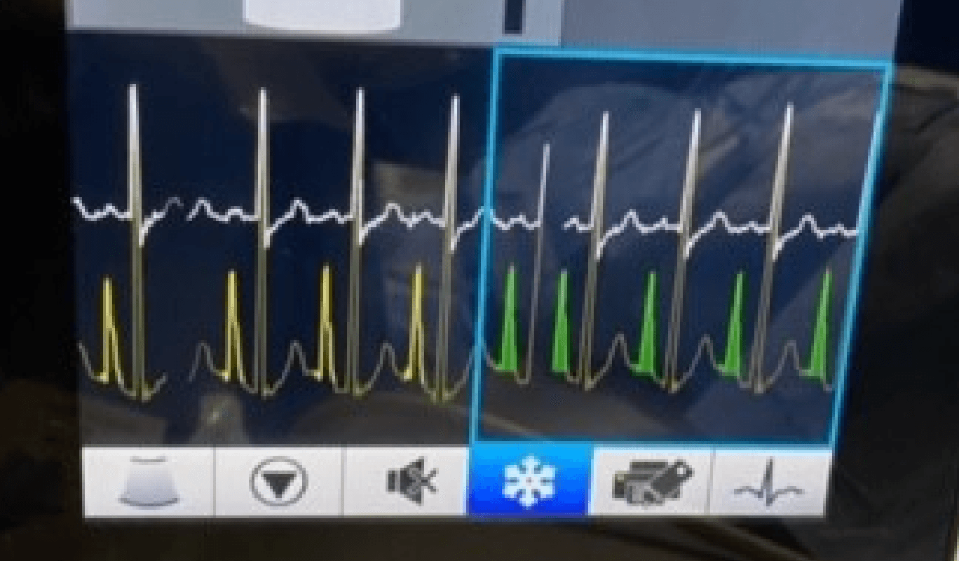 PICC insertion in prone patient