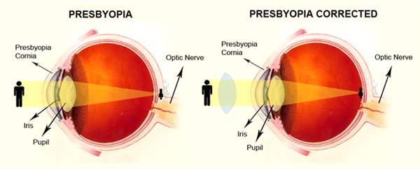 Presbyopia - Optometrists | Masons Eyecare