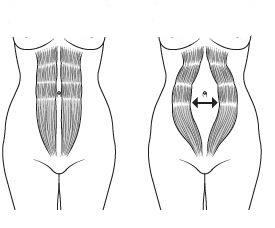 Abdominal Muscle Separation- DRAM