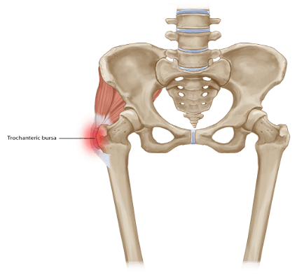 Trochanteric/Hip Bursitis
